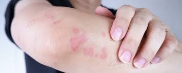 What Is Vasculitis: Symptoms, Causes, and Treatment Guide