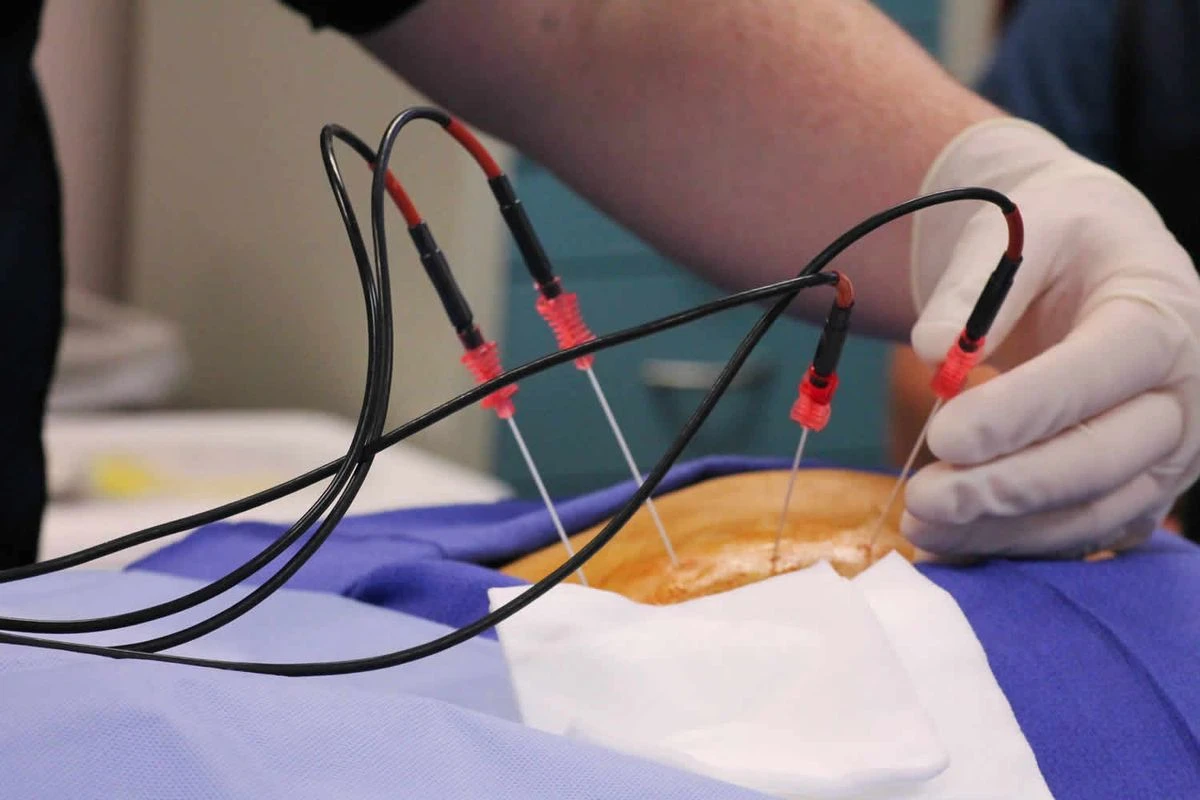 Comprehensive Guide to Radio frequency Ablation